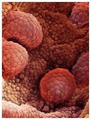 Identificata mutazione genetica nei tumori benigni associati all ...