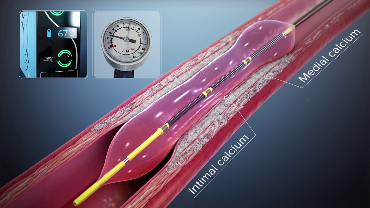 CARDIOLOGIA AL FATEBENEFRATELLI: “NUOVO SISTEMA SHOCKWAVE” PREMIO “BEST ...