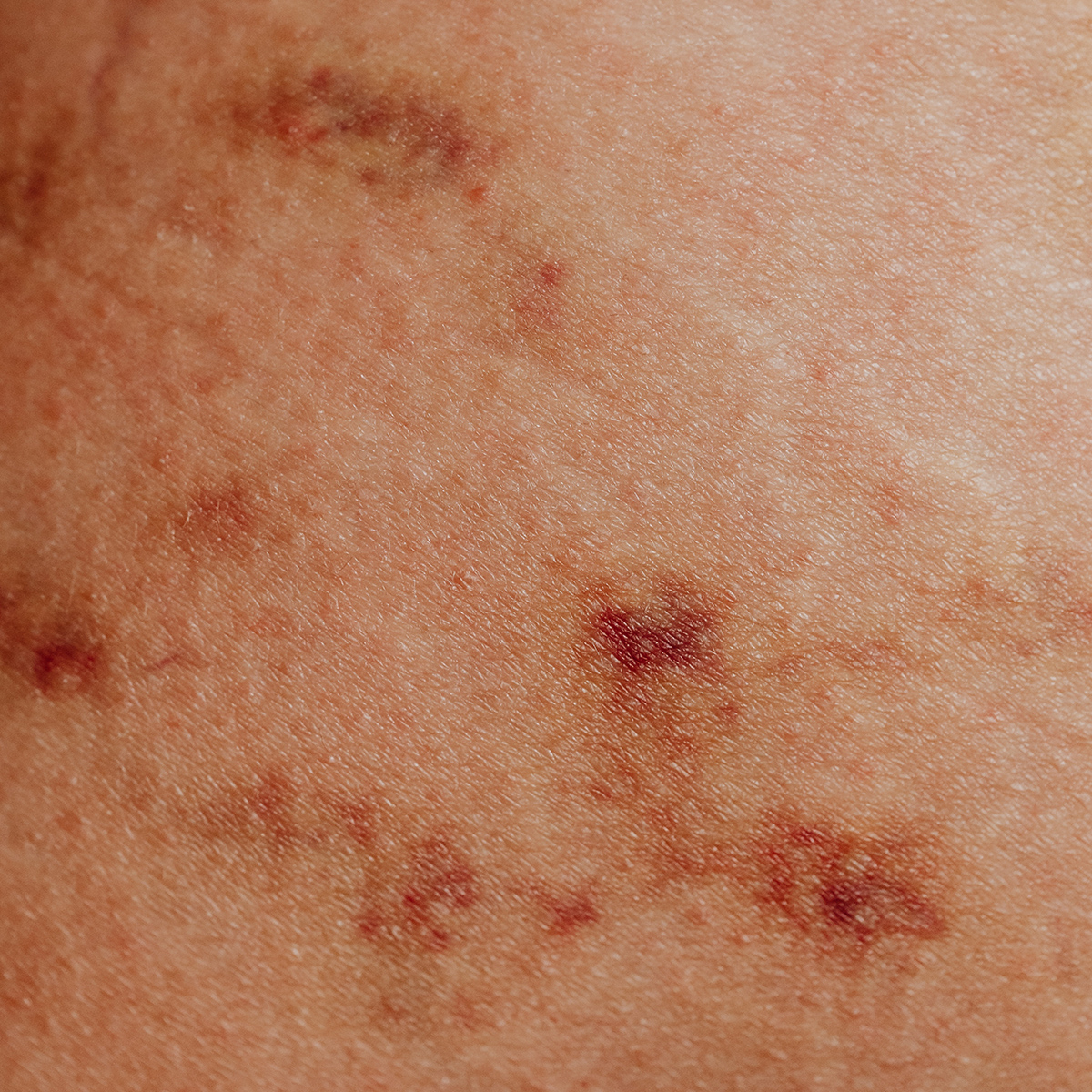 Macchie rosse sulla pelle senza prurito: cause | GoSalute